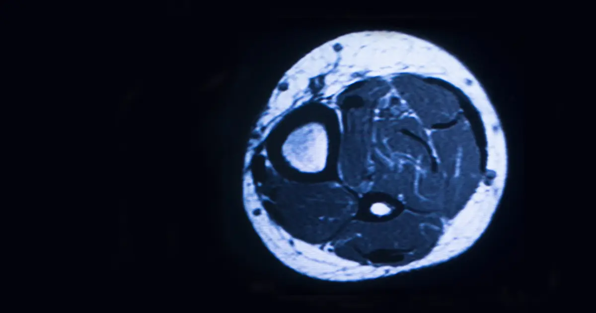 Pediatric Forearm Muscle Herniation Treated With Acellular Dermal ...